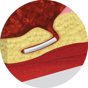 Miro3D® Wound Matrix | Reprise Biomedical