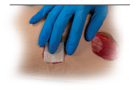 MiroDry™ Wound Matrix | Reprise Biomedical